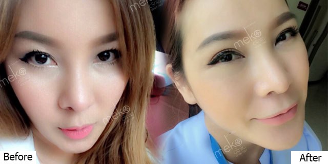 เสริมคาง จากหน้าสั้น เป็นหน้าวีเชฟ โดยแพทย์มนัส