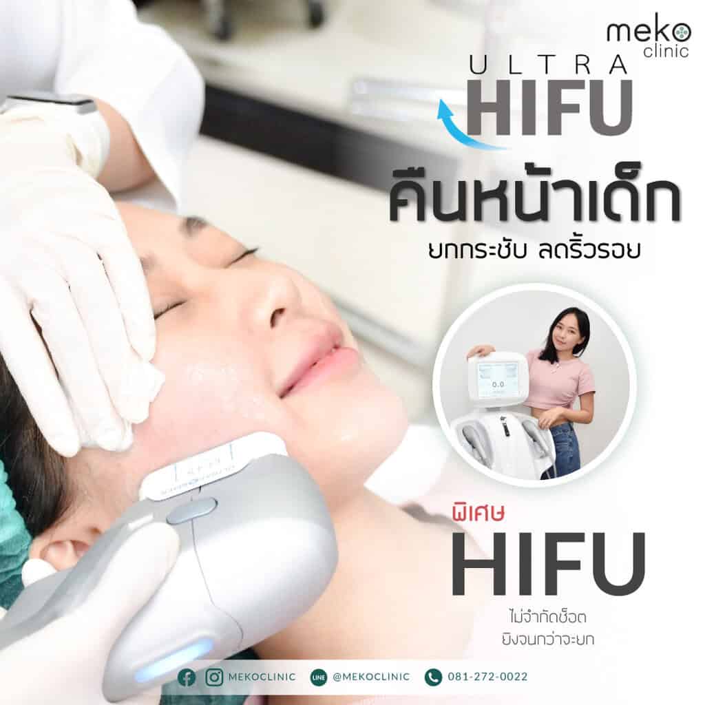 Hifu ลดแก้ม ลดเหนียง สวยสับ ไม่หลับใน โดยแพทย์มิ้ว [คุณเอมมี