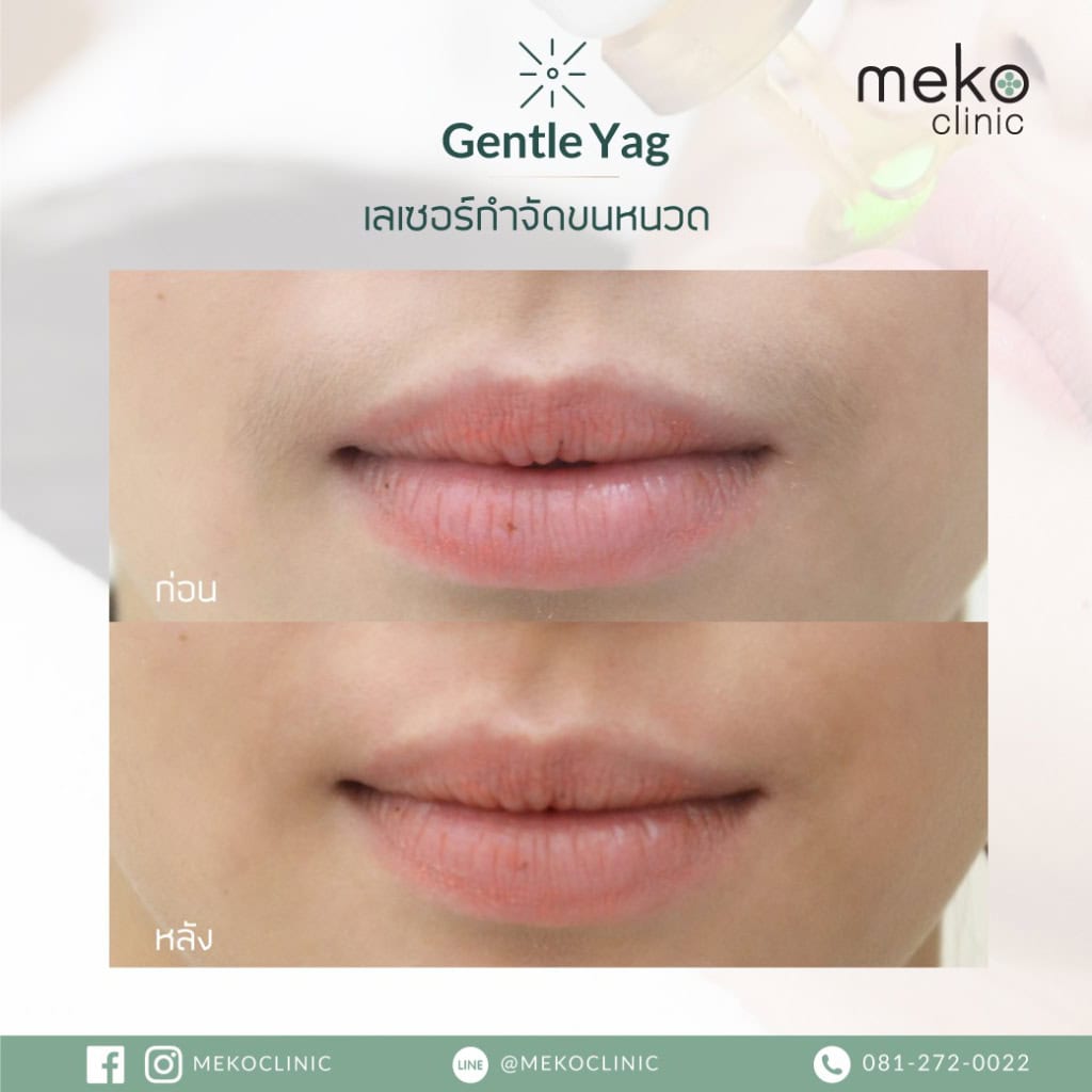 หน้าละมุนทันที ! เลเซอร์หนวดถาวร กำจัดขน ด้วย Gentle Yag - Meko Clinic