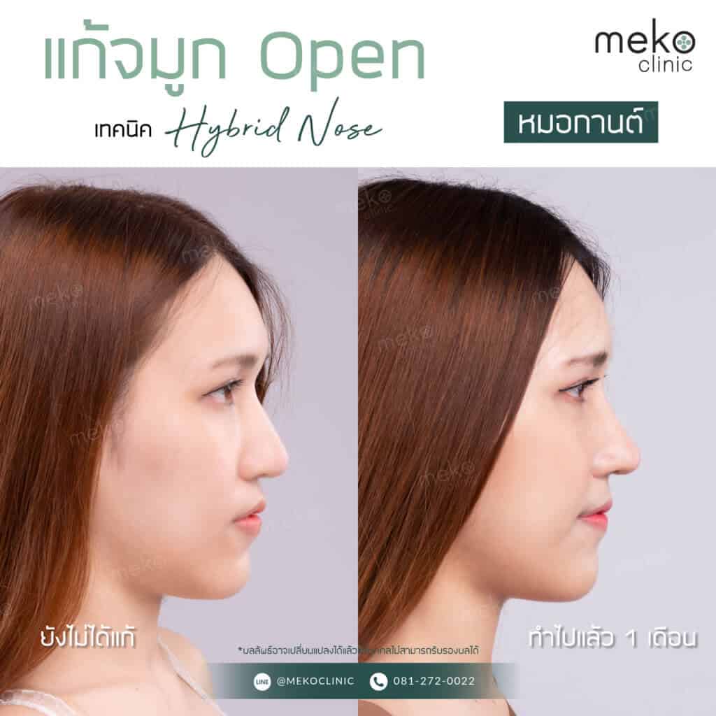 คุณแนน อัปเดต รีวิวแก้จมูกแบบ (nose Open surgery) - เมโกะ คลินิก