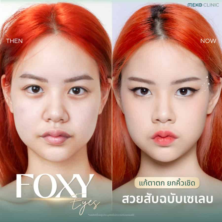 Foxy eye น้องพีช เปลี่ยนสาวหมวยเป็นสาย ฝ สุดแซ่บ - Meko Clinic
