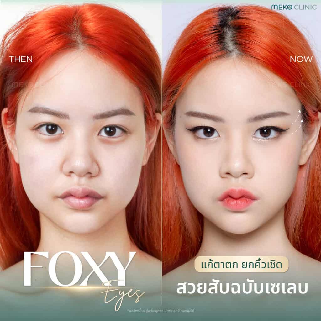 Foxy eye น้องพีช เปลี่ยนสาวหมวยเป็นสาย ฝ สุดแซ่บ - Meko Clinic