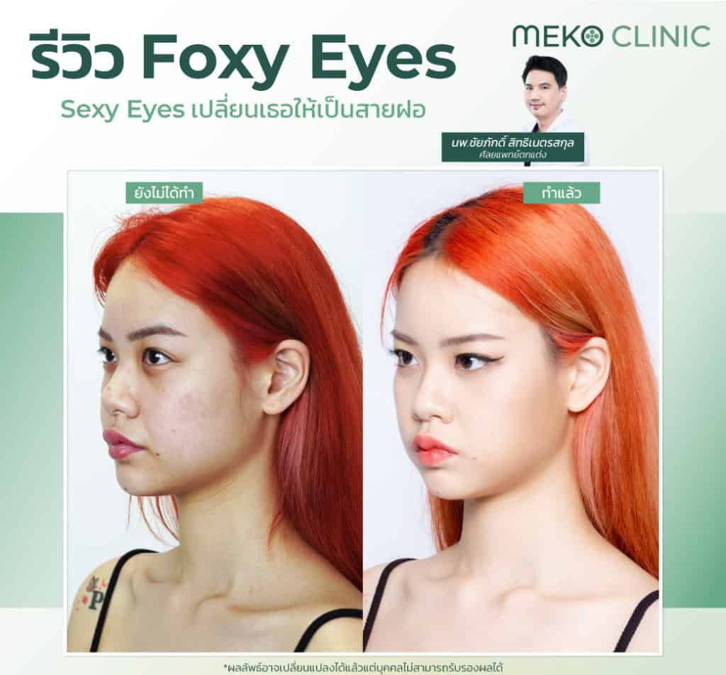 Foxy eye น้องพีช เปลี่ยนสาวหมวยเป็นสาย ฝ สุดแซ่บ - Meko Clinic