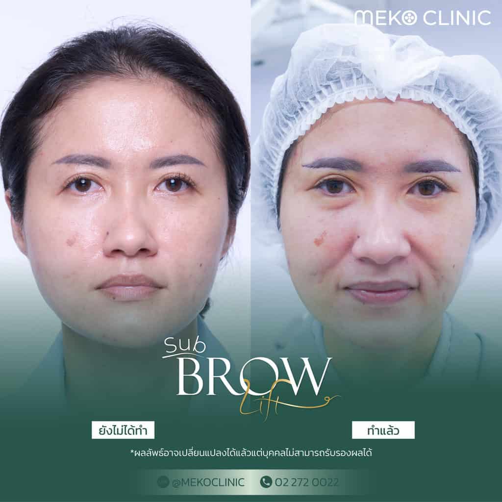 Sub brow lift เทคนิคสุดพิเศษของเมโกะคลินิก โดยศัลยแพทย์ตกแต่ง - Meko Clinic