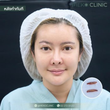 โยมั่นใจ Subbrow-lift ที่เมโกะคลินิก - Meko Clinic