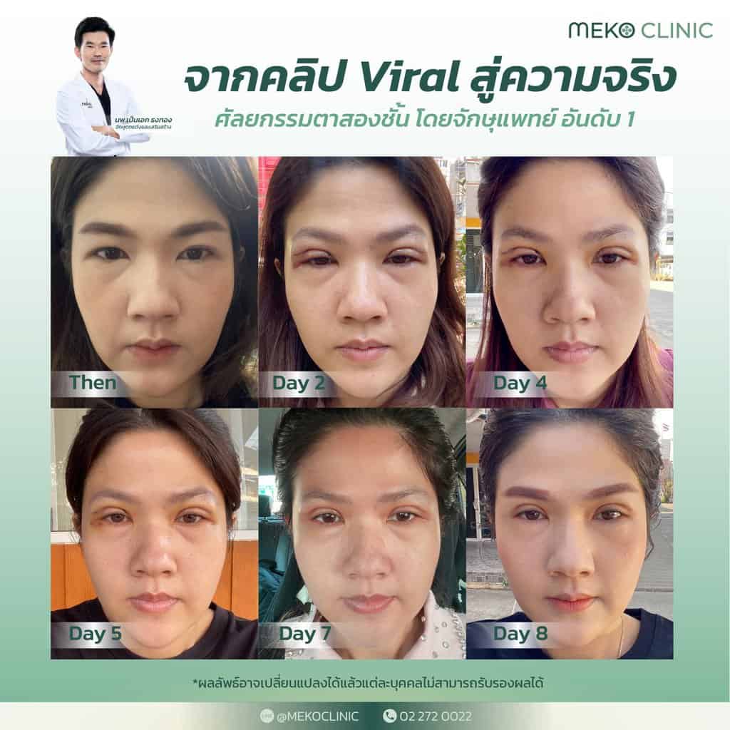 รีวิว ตา สอง ชั้น กรีด ยาว "คุณใหม่ร้านคุณเธอ" - Meko Clinic