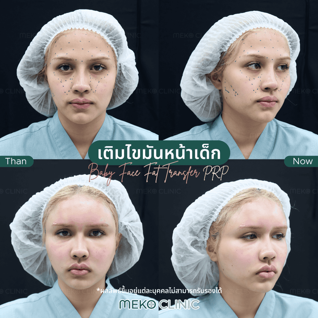 รีวิวฉีดไขมันหน้าเด็ก ทั่วหน้า ไม่จำกัดCC - Meko Clinic