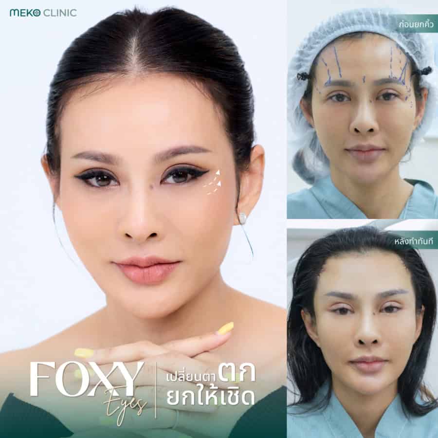 Foxy eyes เทรนตาเฉี่ยว เปรี้ยวแบบสายฝอ - Meko Clinic
