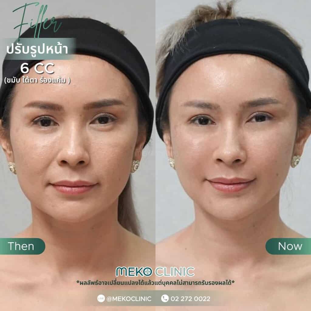 ไฮโซสาวคุณดา บินตรงจากลาวมาเติมฟิลเลอร์ หน้าเด็ก ที่เมโกะ คลินิก - Meko ...