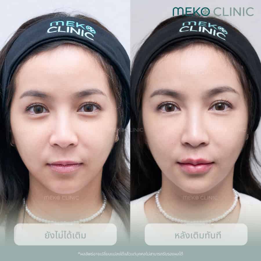 ครั้งแรกของกับการเติมฟิลเลอร์ Juvederm จอย ไกอา มีปัญหาใต้ตาลึก ปากบาง ...