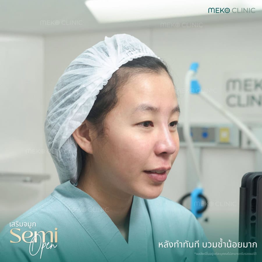 รีวิวเสริมจมูก จมูกSemi ตะไบจมูก ตกแต่งปลายจมูก โดยคุณศานันทินี ทิศแก้ว ...